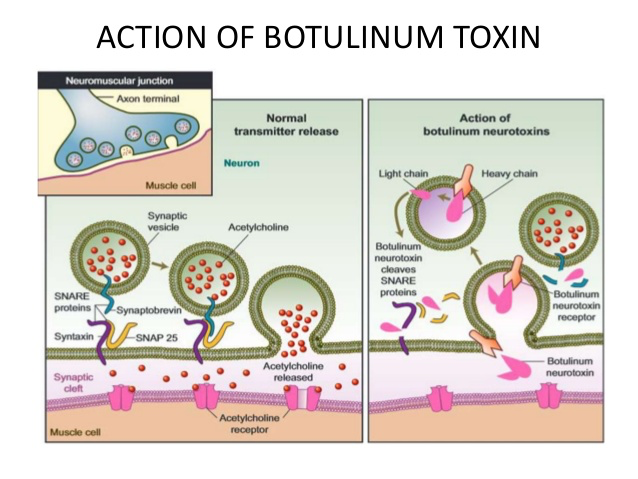 Botox vs Filler: Decoding the Differences • LA Longevity