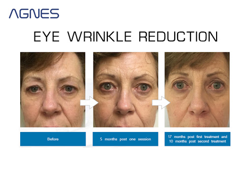 Agnes RF • LA Longevity