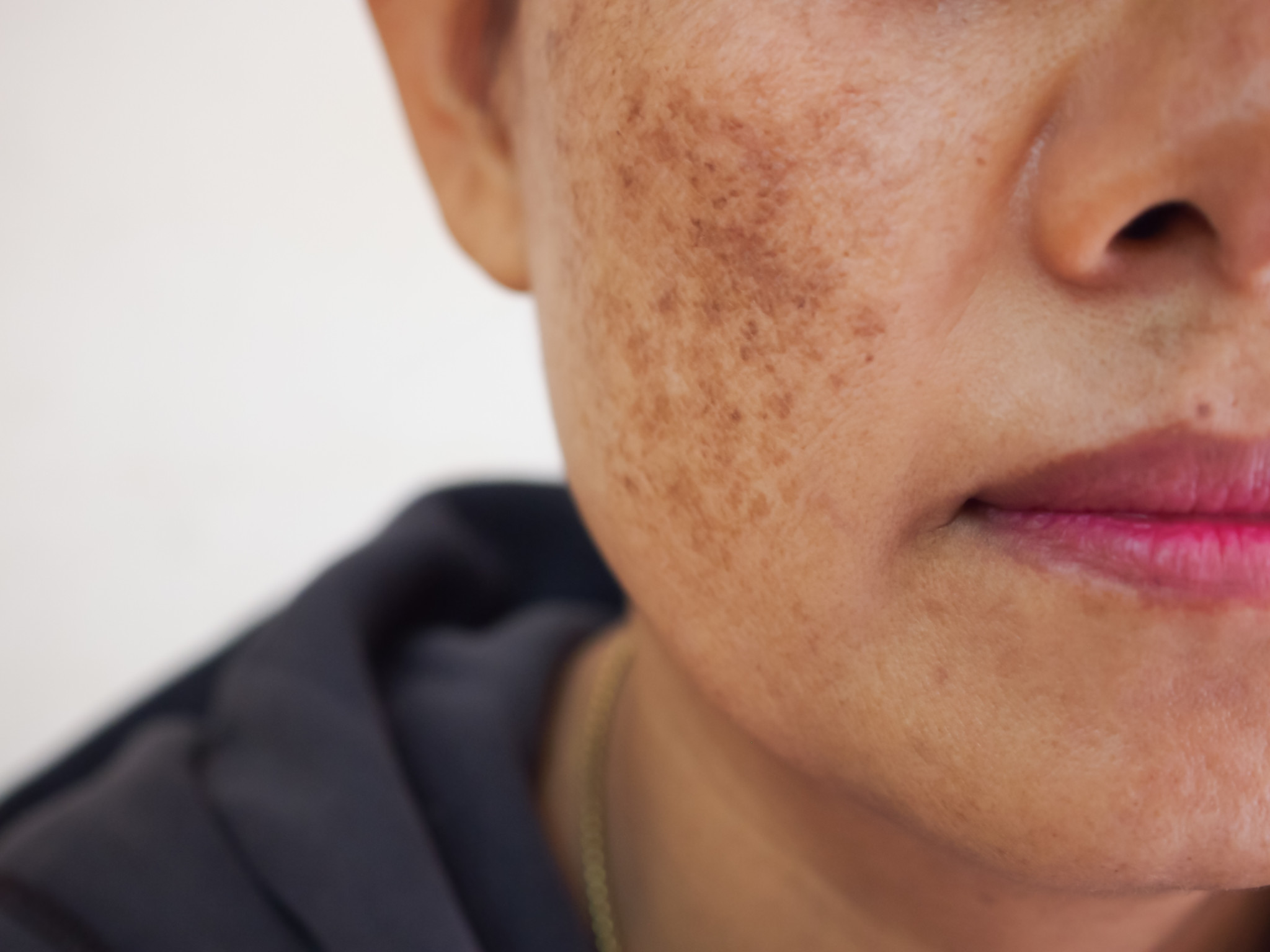 My, My, Melasma! • LA Longevity
