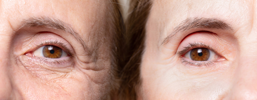 Botox How I Lift My Hooded Eyes As I Age • La Longevity